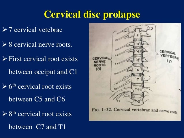 Cervical disc prolapse