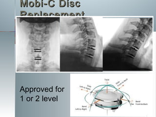 Cervical Disc Replacement Surgery | PPT