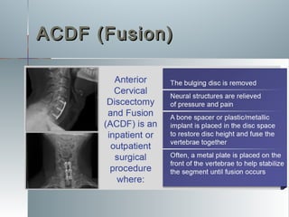 Cervical Disc Replacement Surgery | PPT