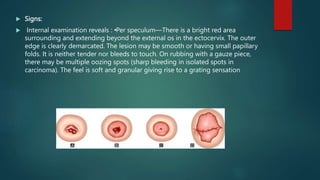 Cervical Ectopy or cervical erosion.pptx