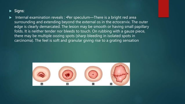 Cervical Ectopy or cervical erosion.pptx
