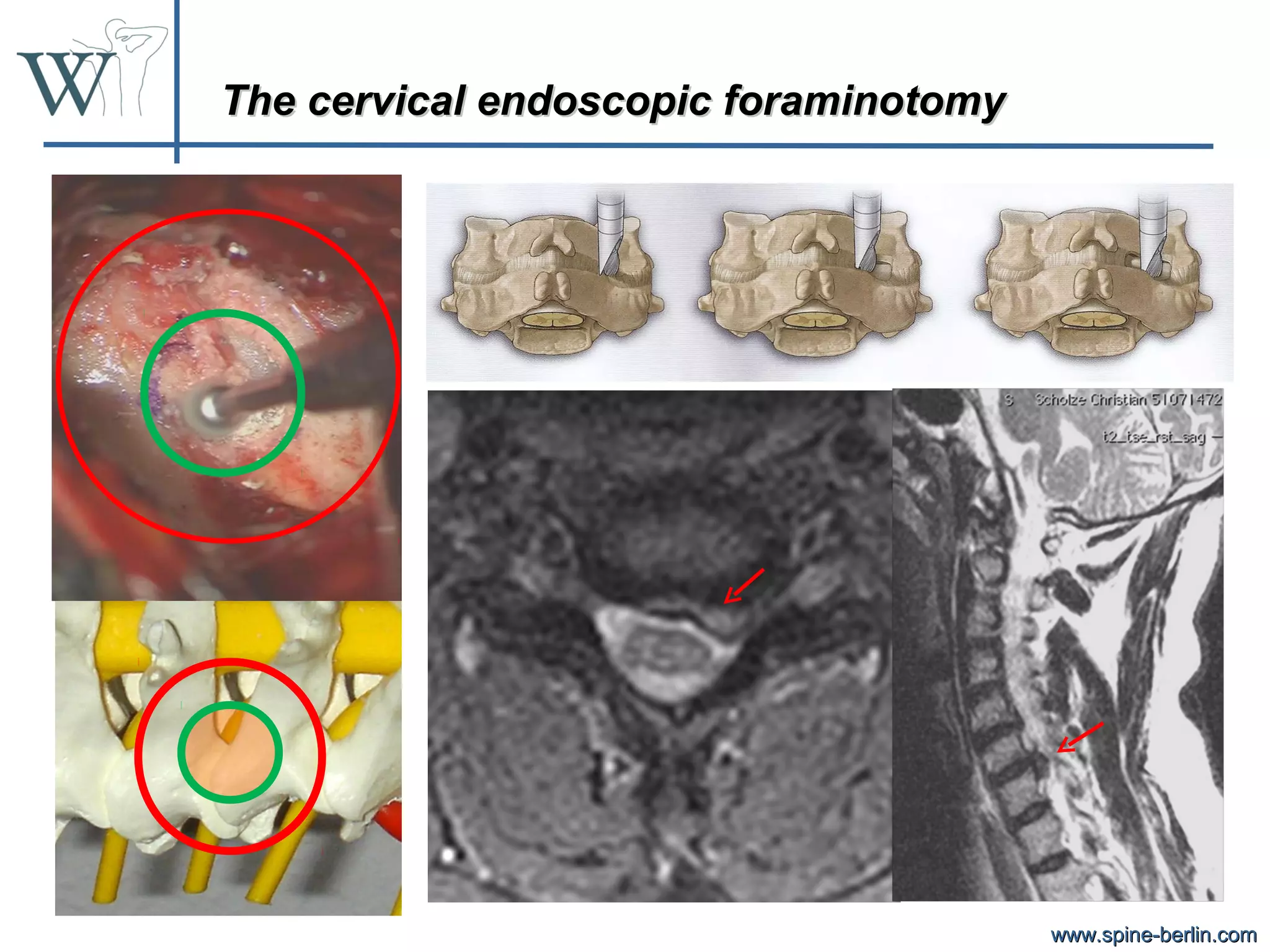Cervical endoscopy | PPT