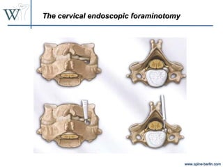 Cervical endoscopy | PPT