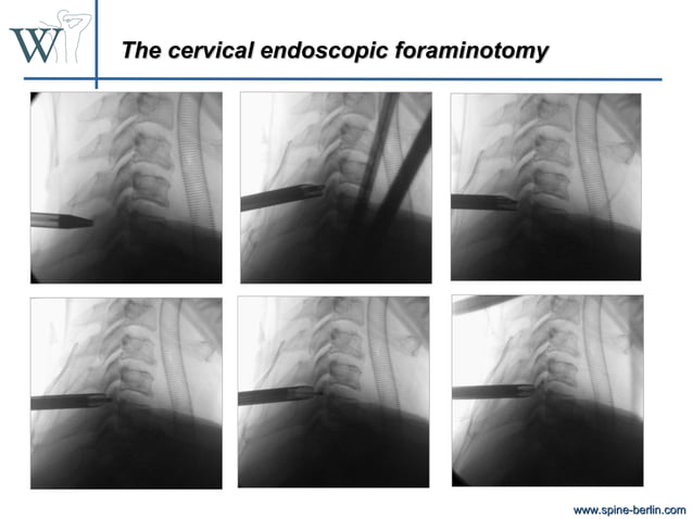 Cervical endoscopy | PPT