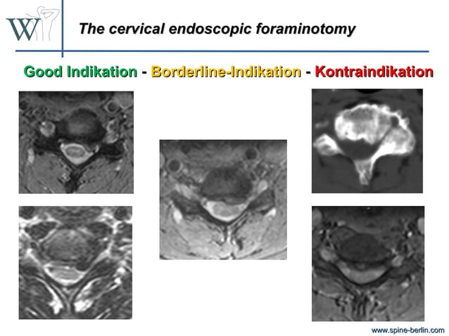 Cervical endoscopy | PPT