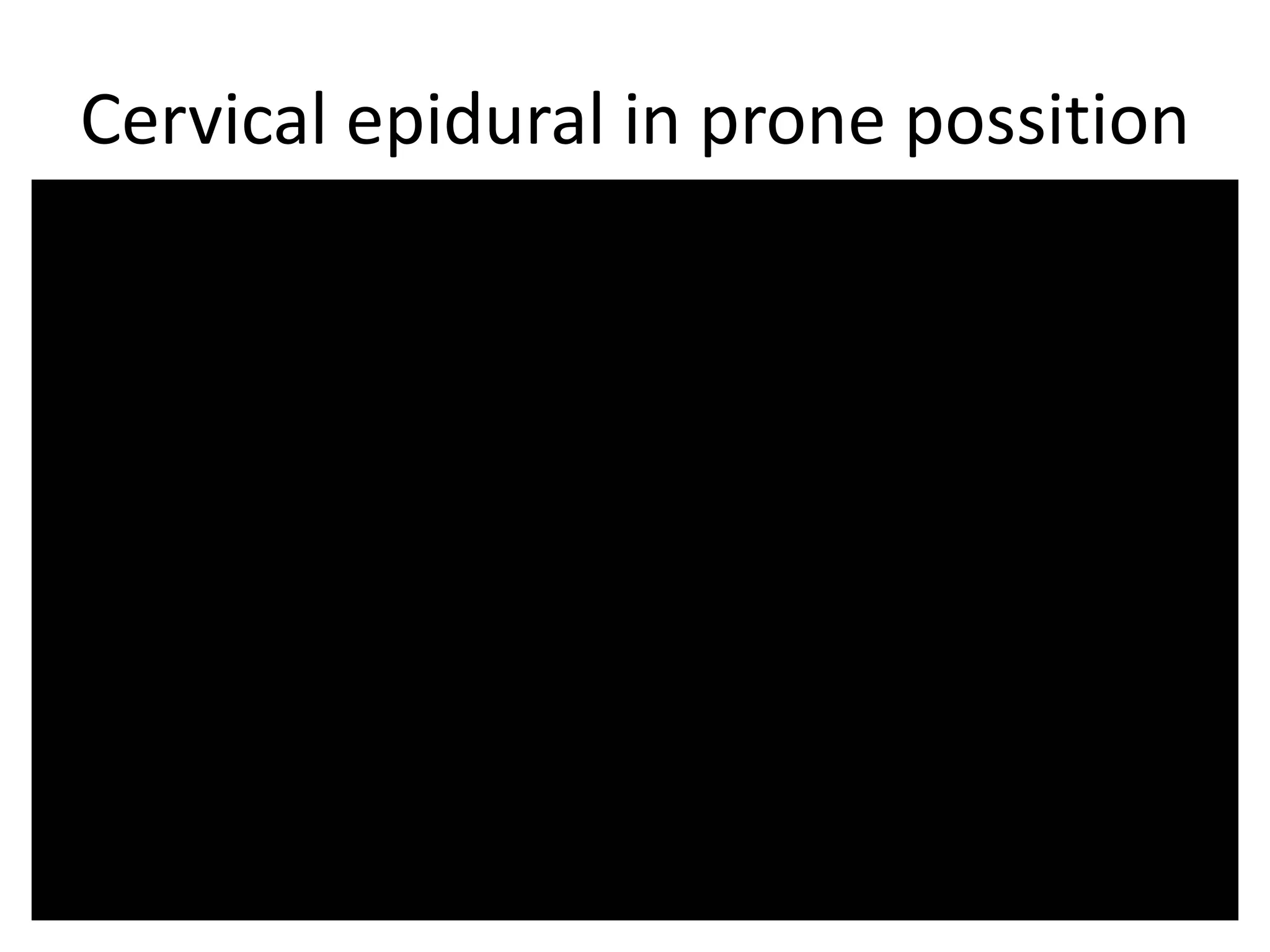 Cervical epidural how to play safe | PPT