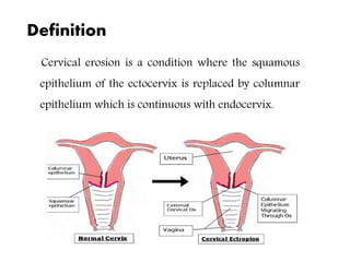 Cervical erosion | PPT