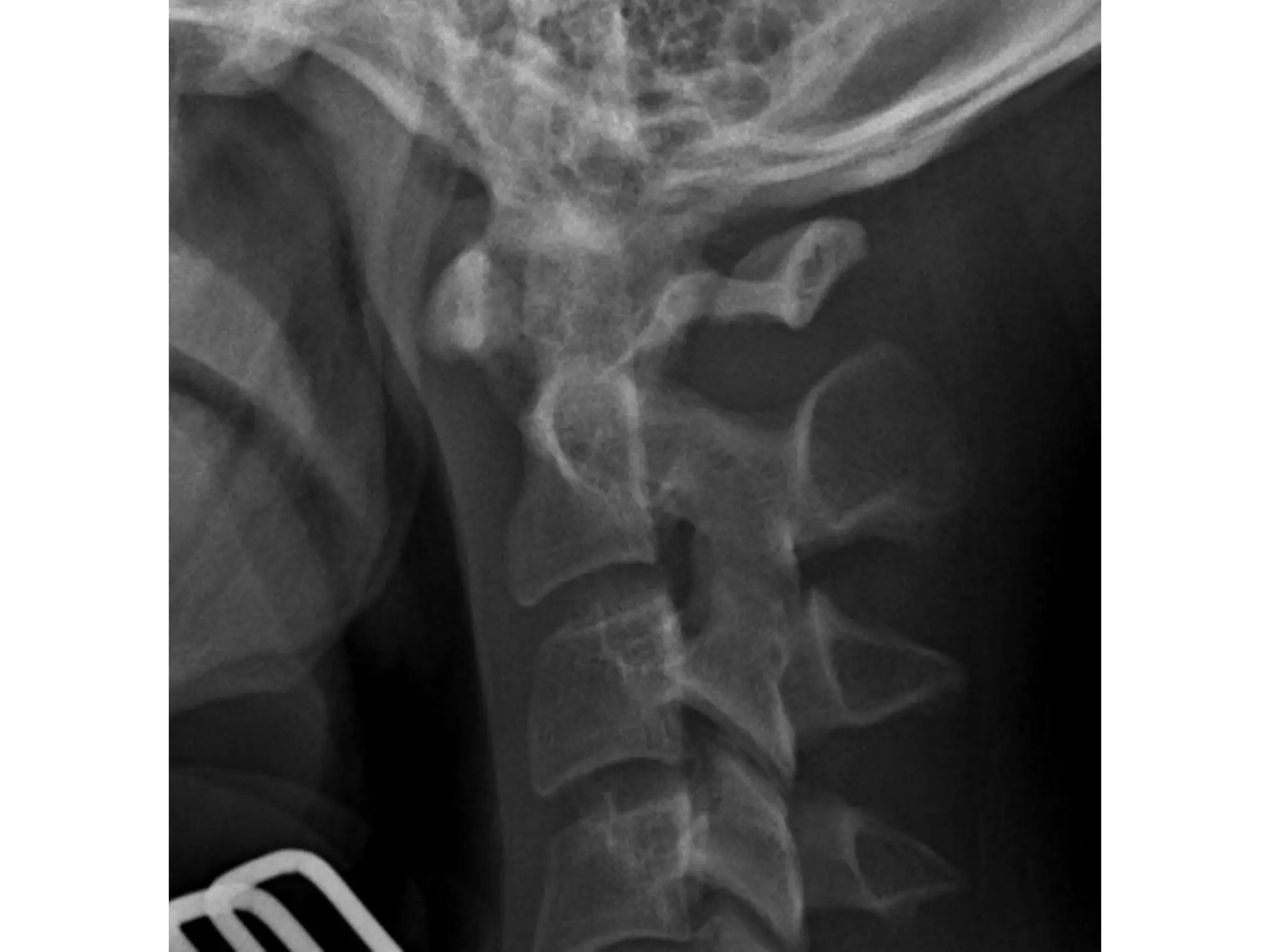 Cervical fracture and injuries Presentation | PPT