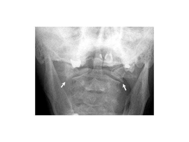 Cervical fracture and injuries Presentation | PPT