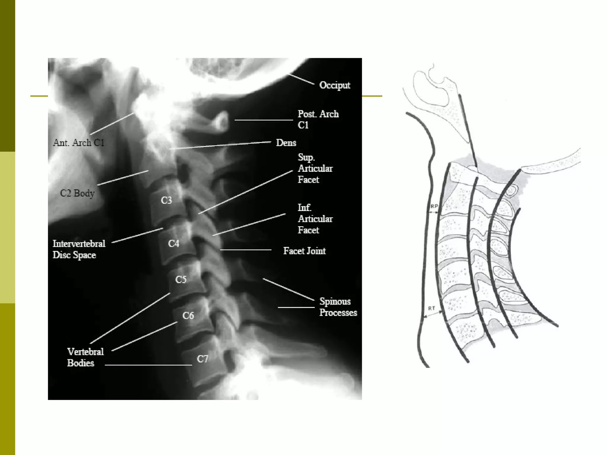 Cervical fracture | PPT