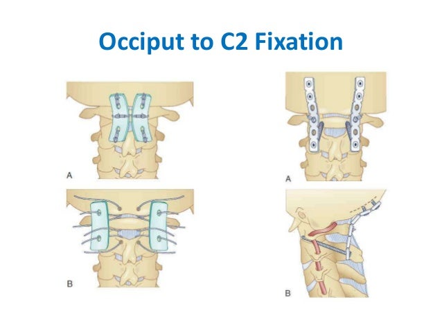 Cervical fractures
