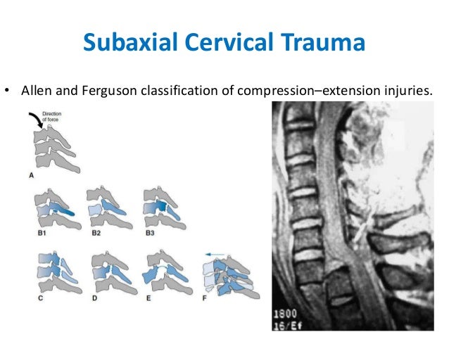 Cervical fractures