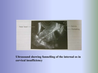 Cervical incompetence | PPTX