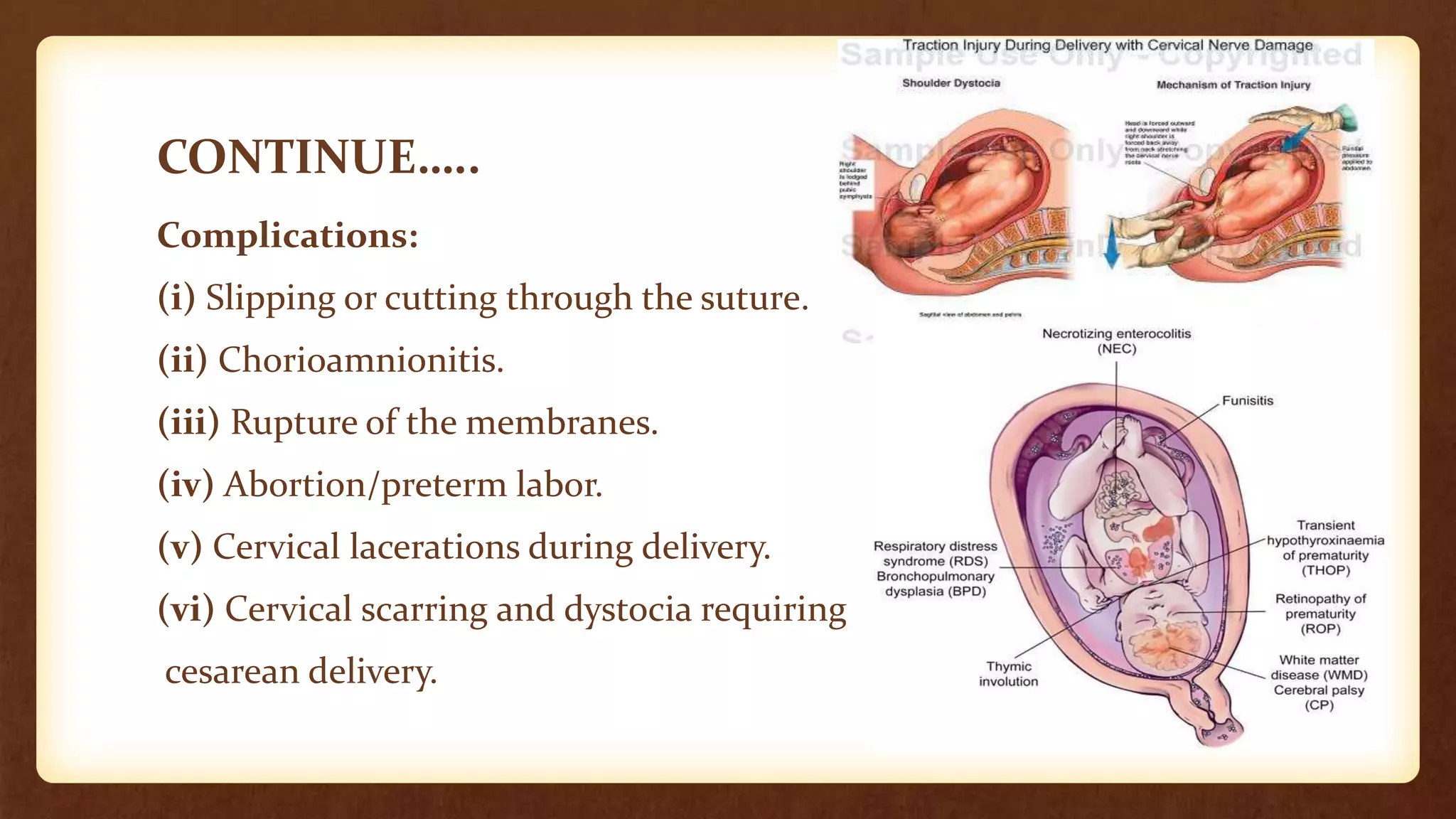 Cervical incompetence | PPTX