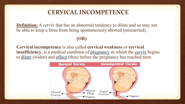 Cervical incompetence | PPTX