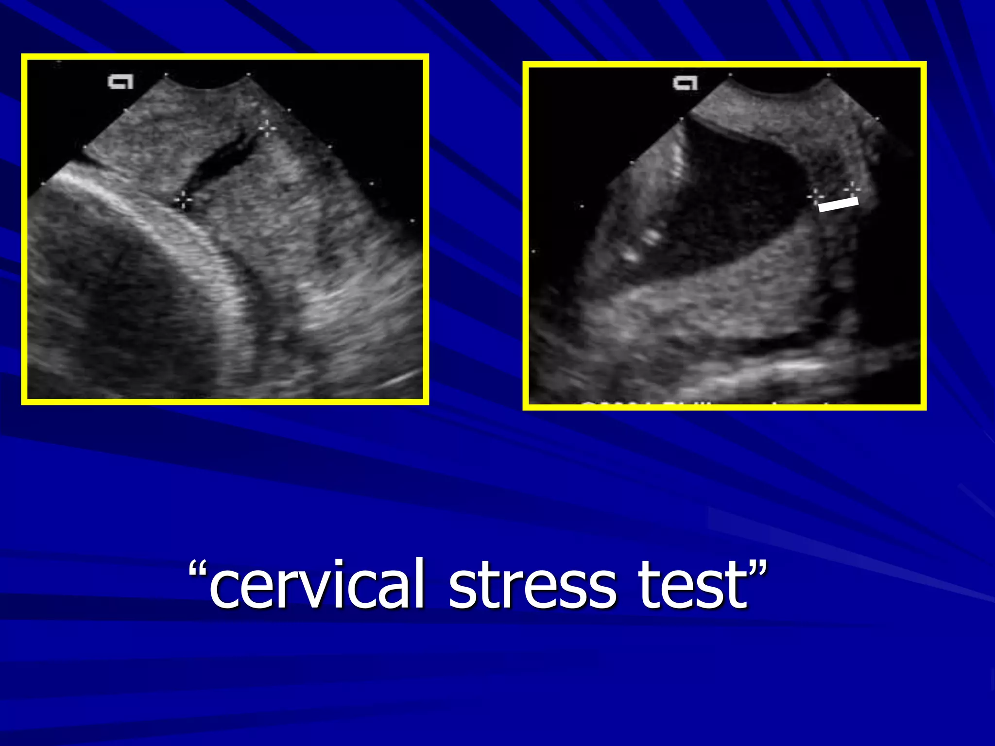 Cervical incompetence | PPT