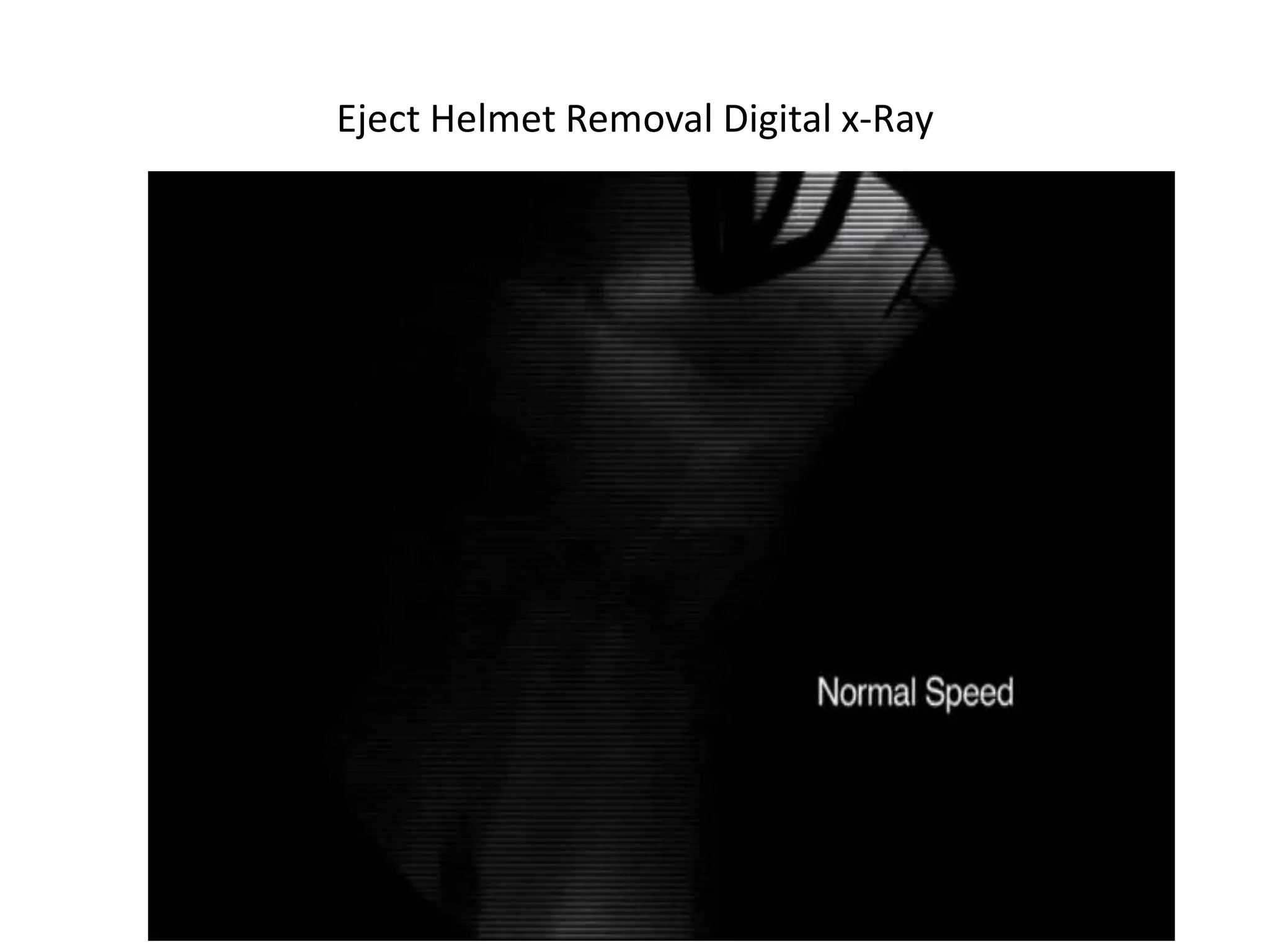 Cervical Injuries And Blunt Trauma ICMS | PPTX
