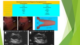 Cervical insufficiency | PPTX