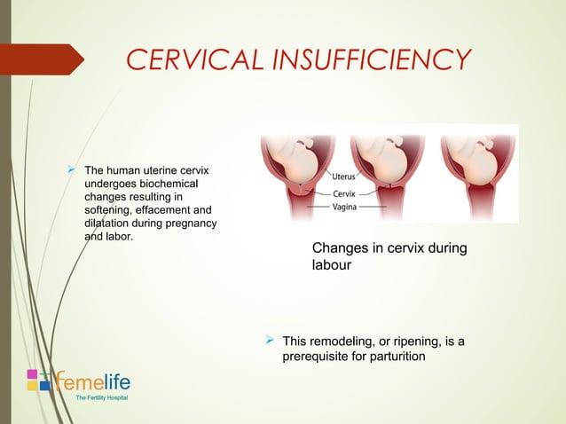 Cervical insufficiency | PPT