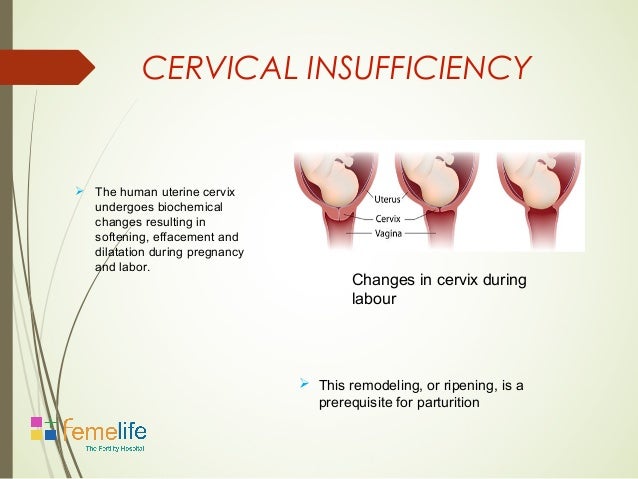 Cervical insufficiency