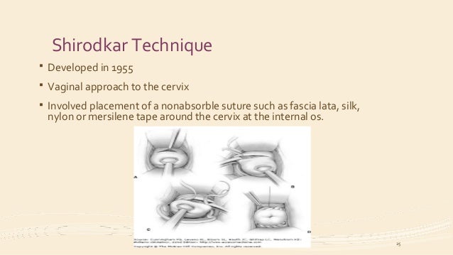 Cervical insufficiency