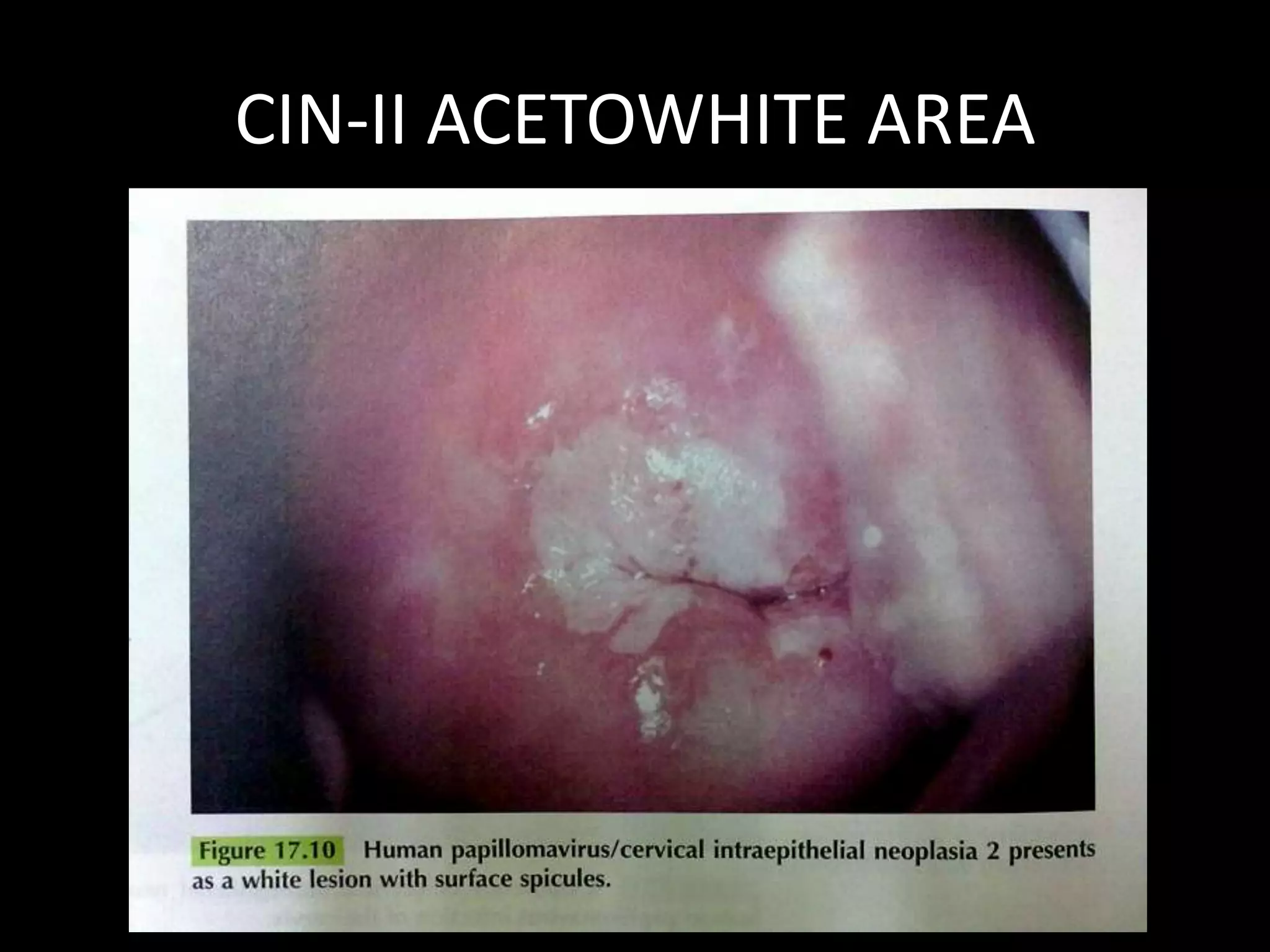 Cervical intraepithelial neoplasia | PPTX