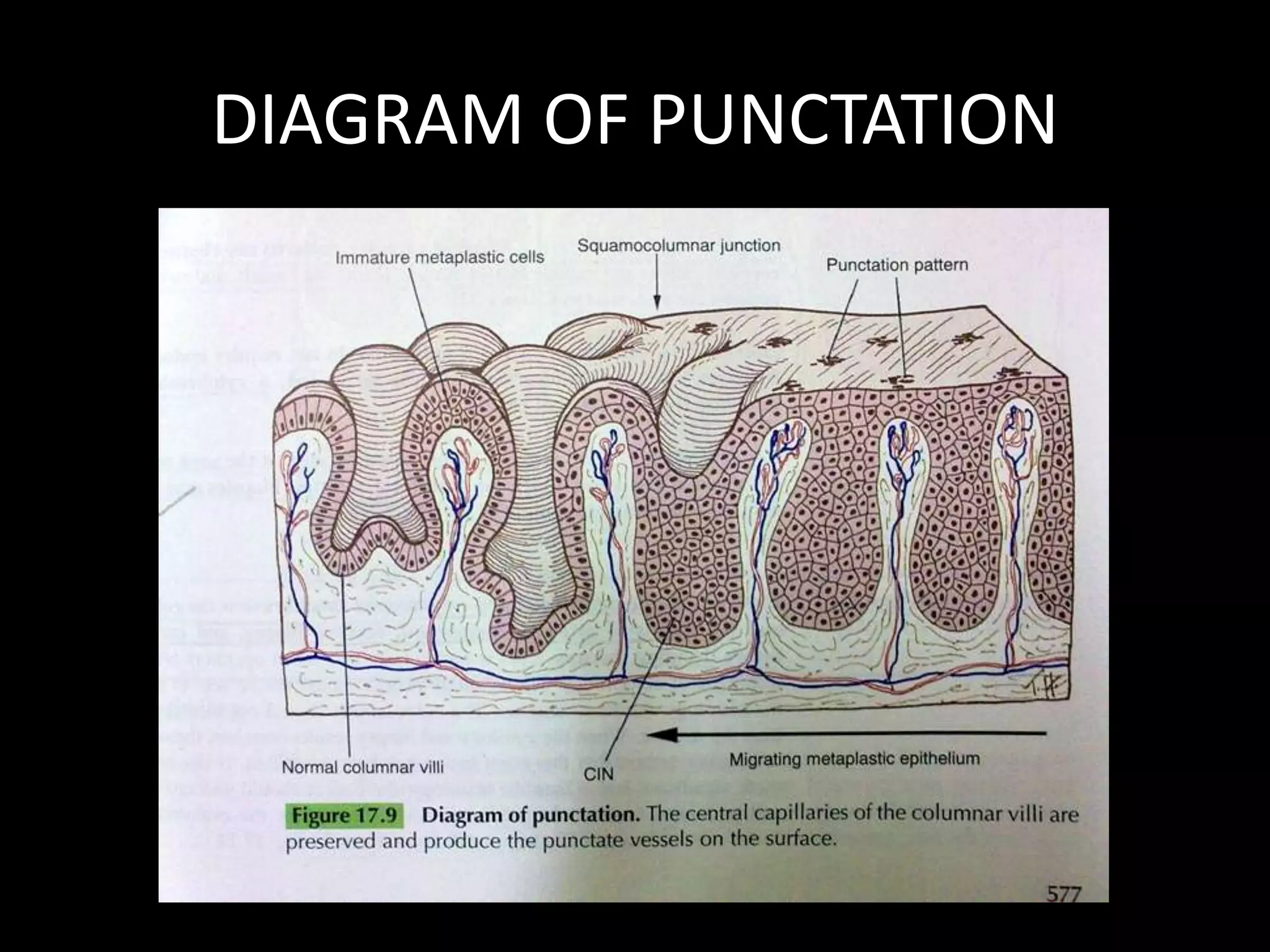 Cervical intraepithelial neoplasia | PPTX