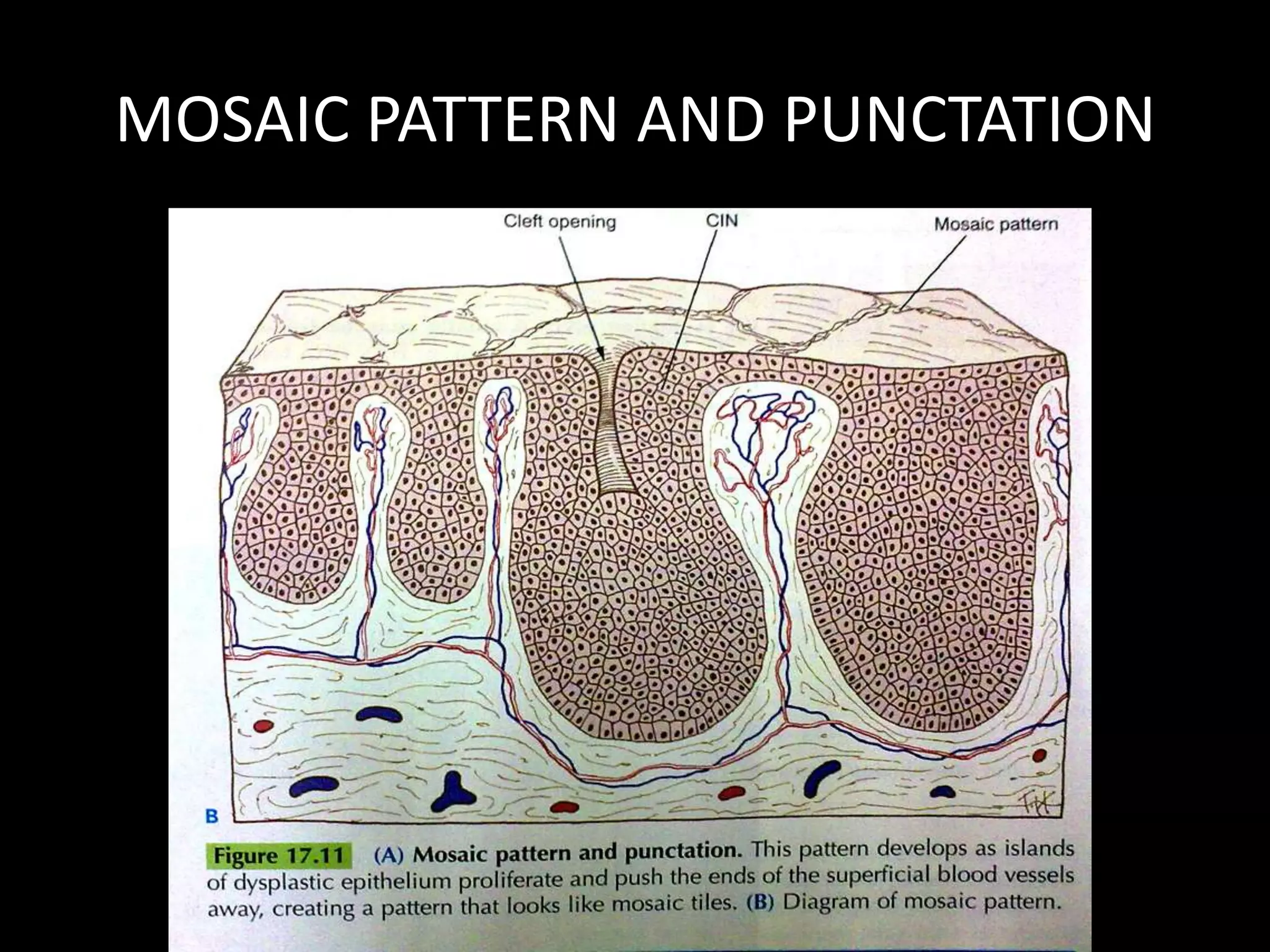 Cervical intraepithelial neoplasia | PPTX