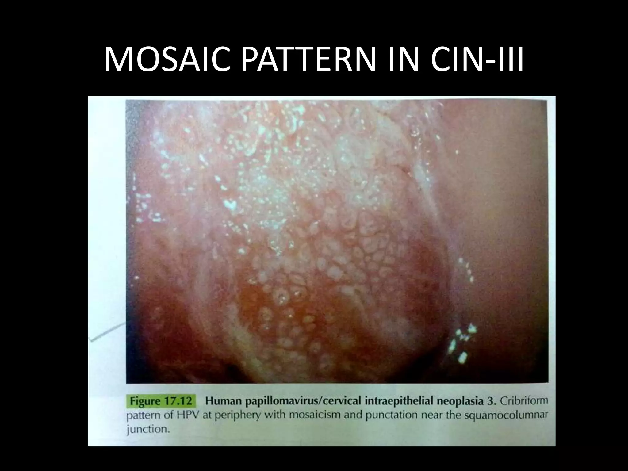 Cervical intraepithelial neoplasia | PPTX