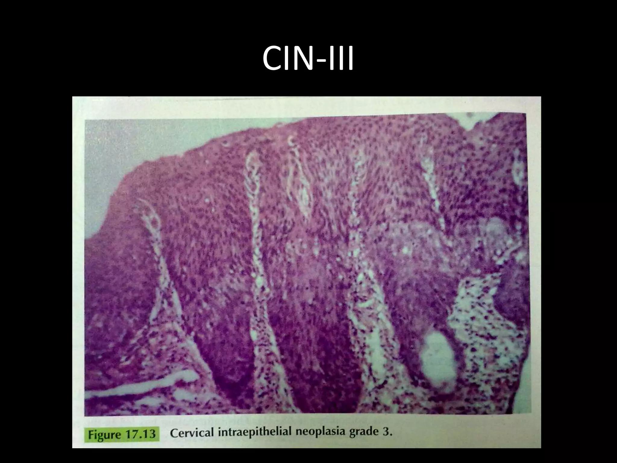 Cervical intraepithelial neoplasia | PPTX