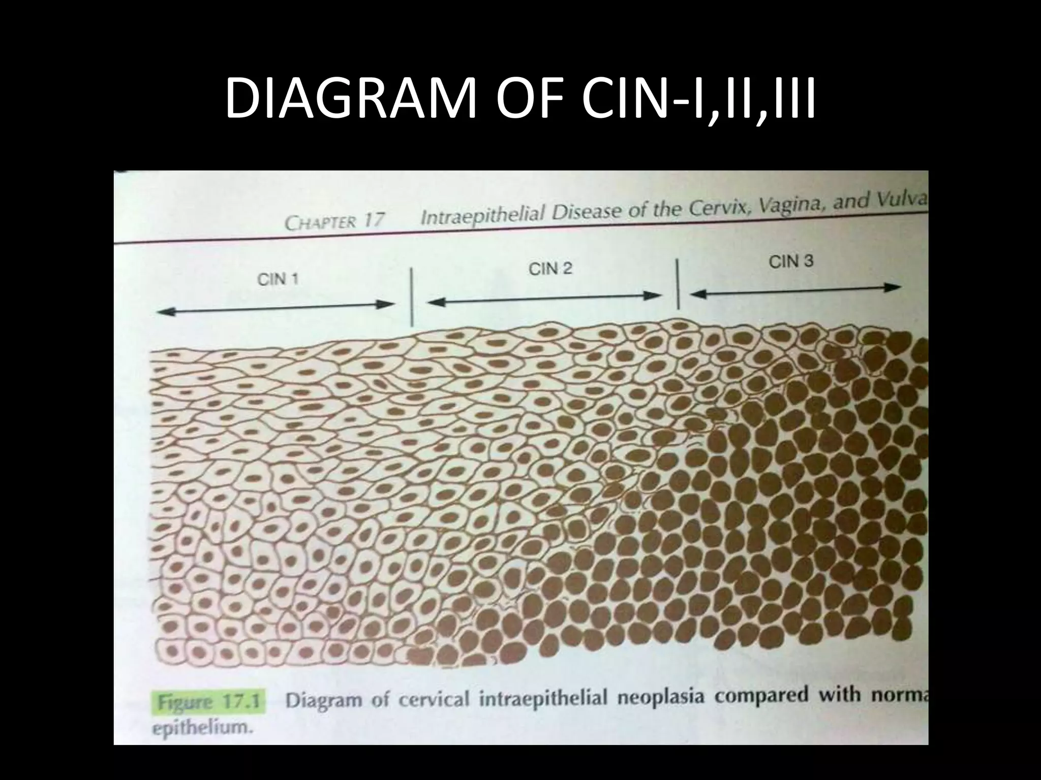 Cervical intraepithelial neoplasia | PPTX
