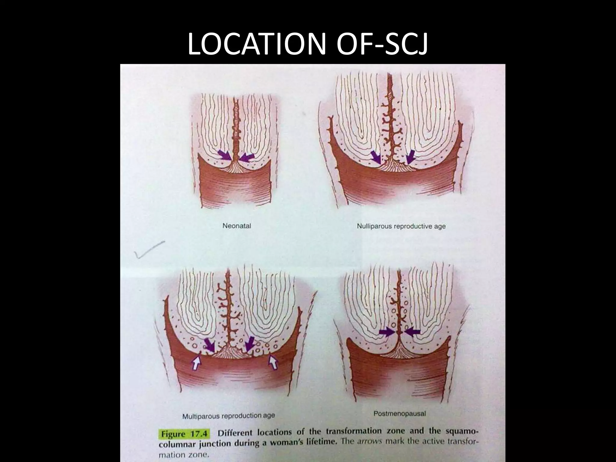 Cervical intraepithelial neoplasia | PPTX
