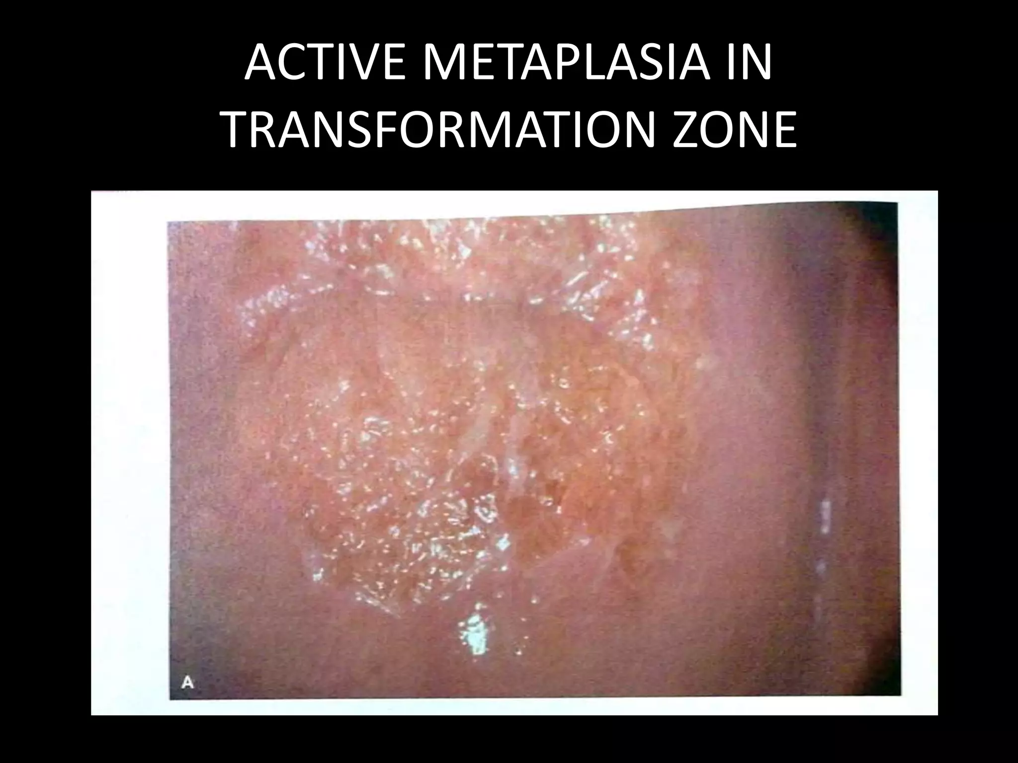 Cervical intraepithelial neoplasia | PPTX