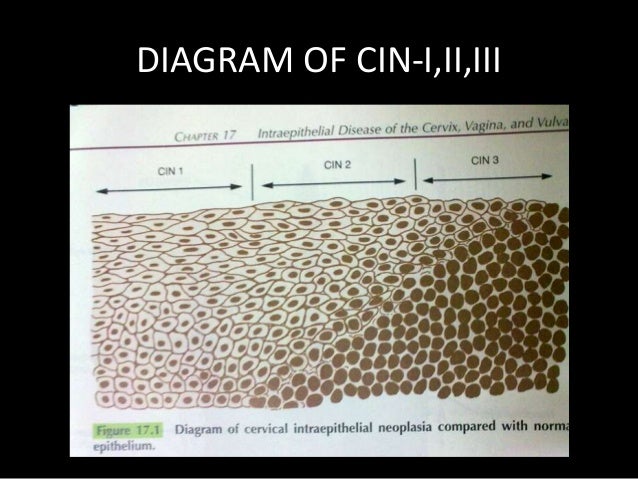 Cervical intraepithelial neoplasia