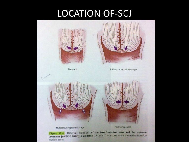 Cervical intraepithelial neoplasia