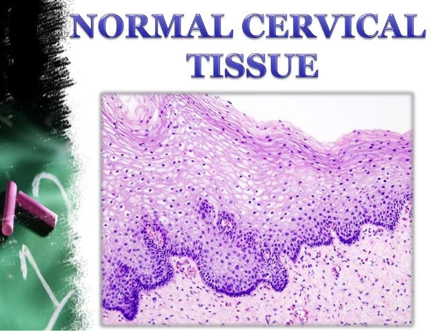 Cervical Intraepithelial Neoplasia Grade 1
