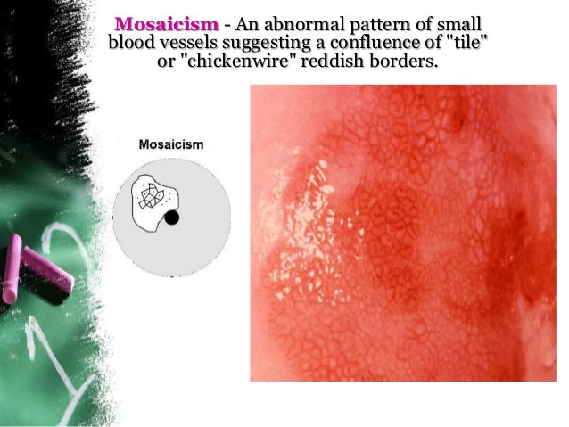 Cervical intraepithelial neoplasia
