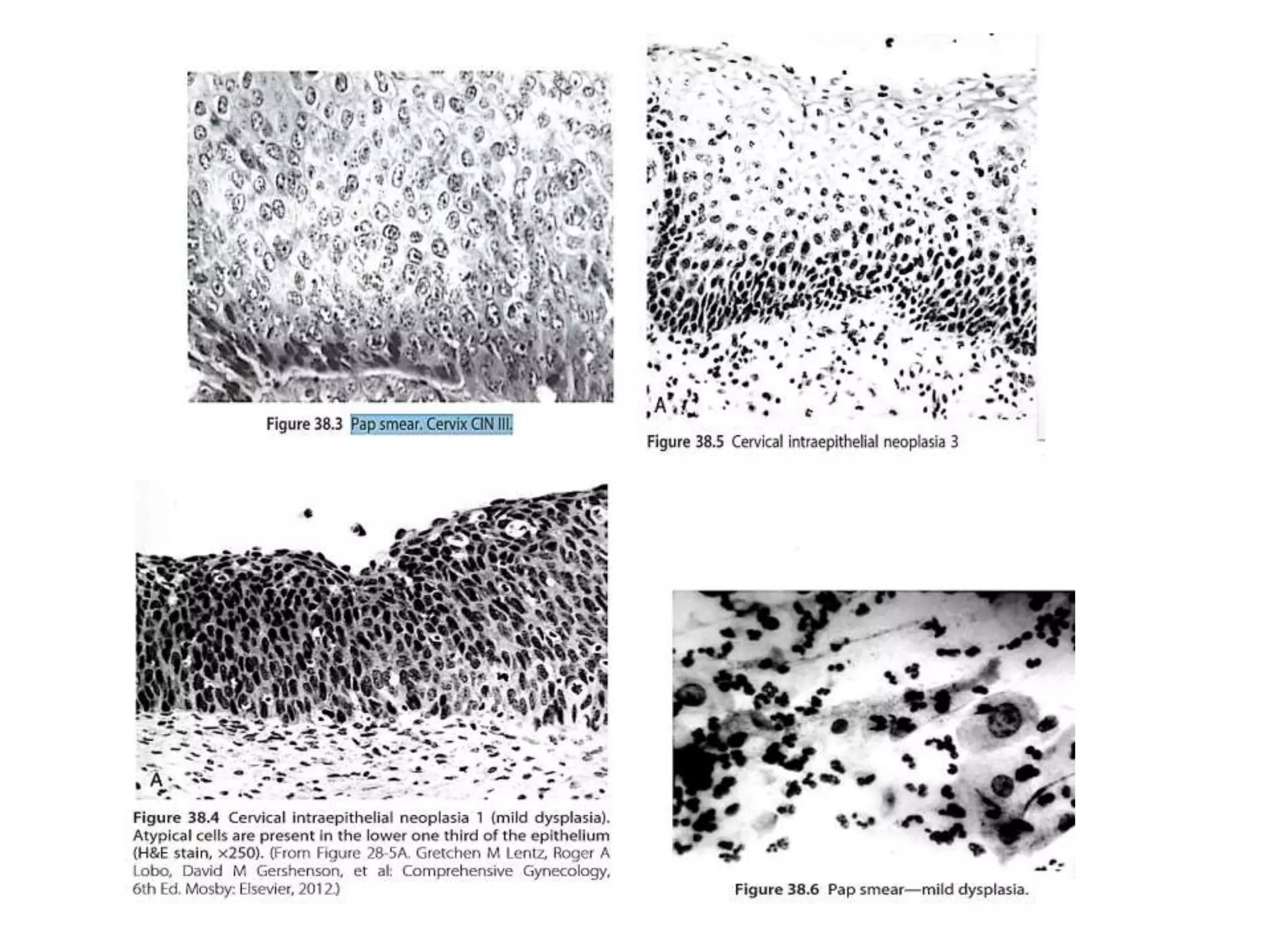 Cervical intraepithelial neoplasia, carcinoma of cervix | PPT