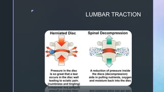 Cervical & lumbar traction | PPT