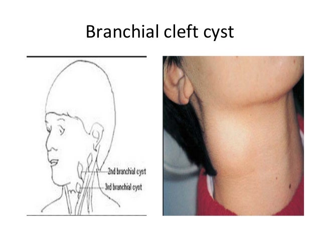 Branchial Cyst Anatomy
