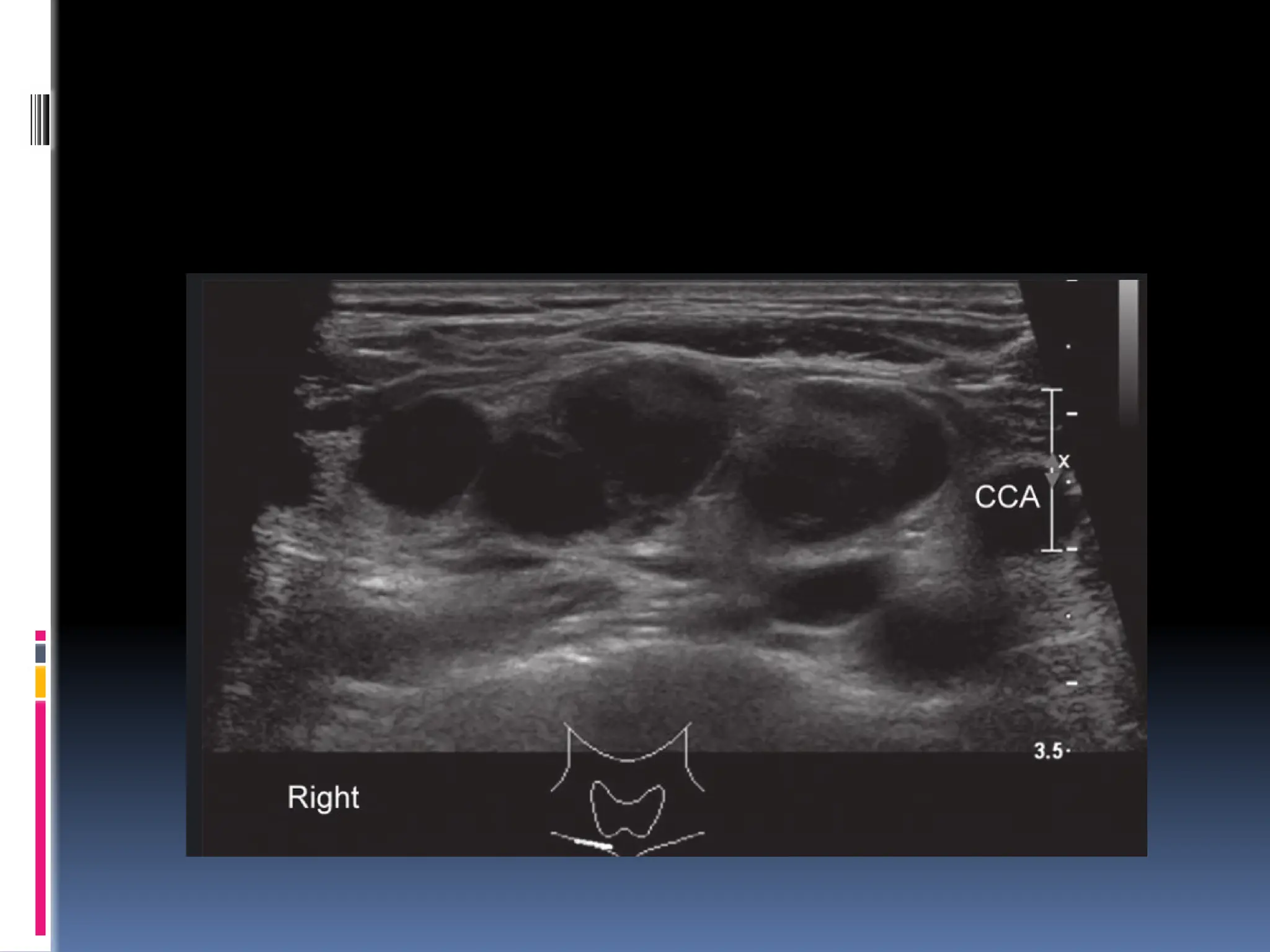 CERVICAL LYPHADENOPATHY ON USG AND CLASSIFICATION.pptx