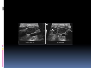 CERVICAL LYPHADENOPATHY ON USG AND CLASSIFICATION.pptx