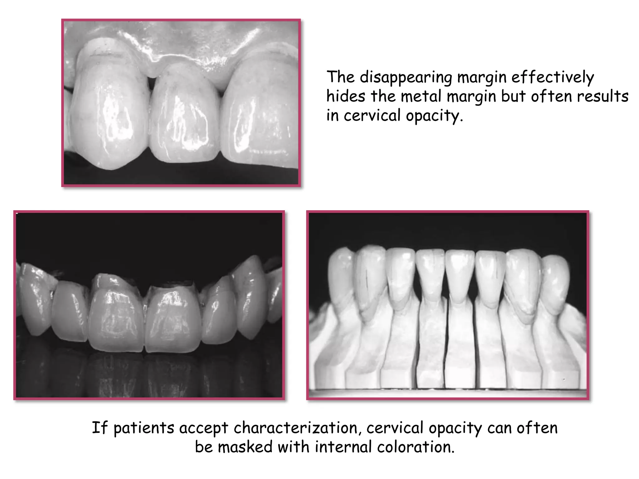 Cervical margin design | PPTX