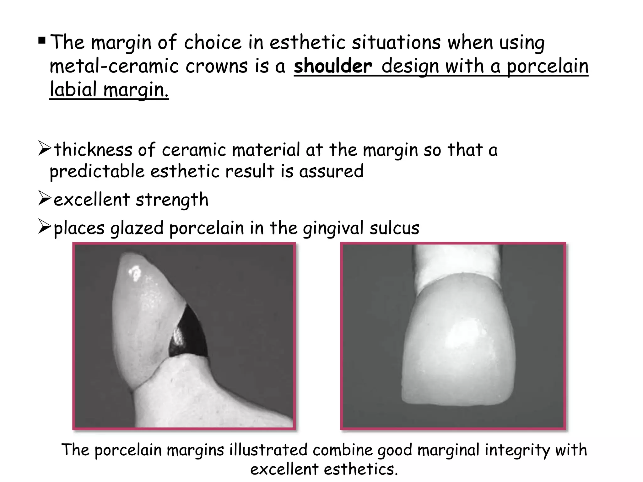 Cervical margin design | PPTX