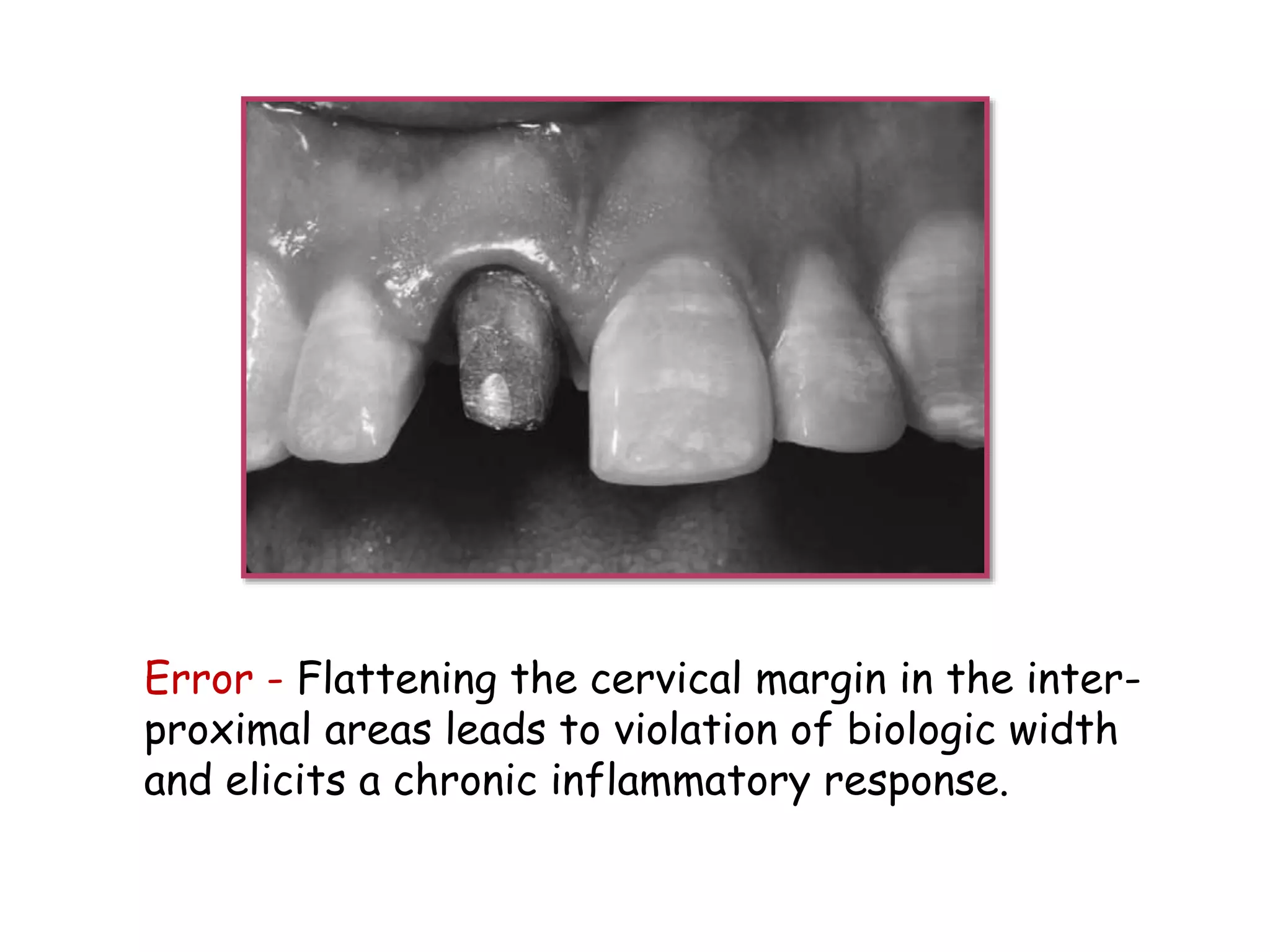 Cervical margin design | PPTX