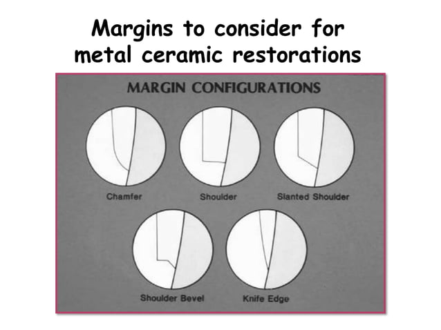 Cervical margin design | PPT