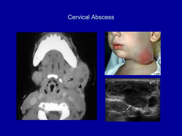 Cervical mases DDx and Radio-imaging by B.H.A.A Malik | PPT
