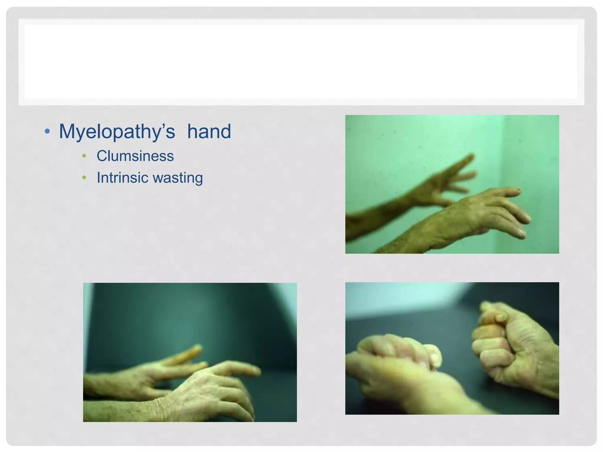 Cervical myelopathy | PPTX