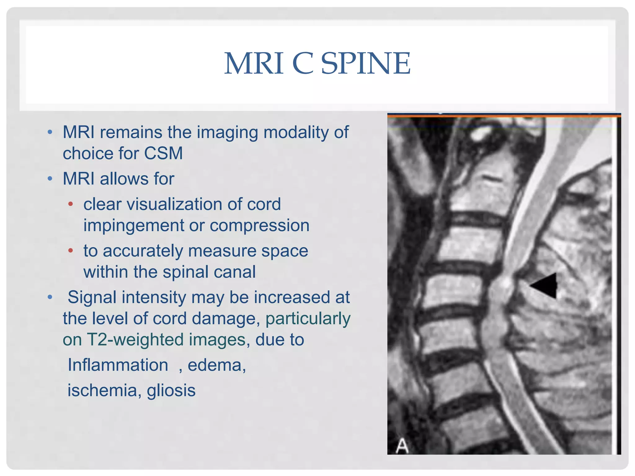 Cervical myelopathy | PPTX