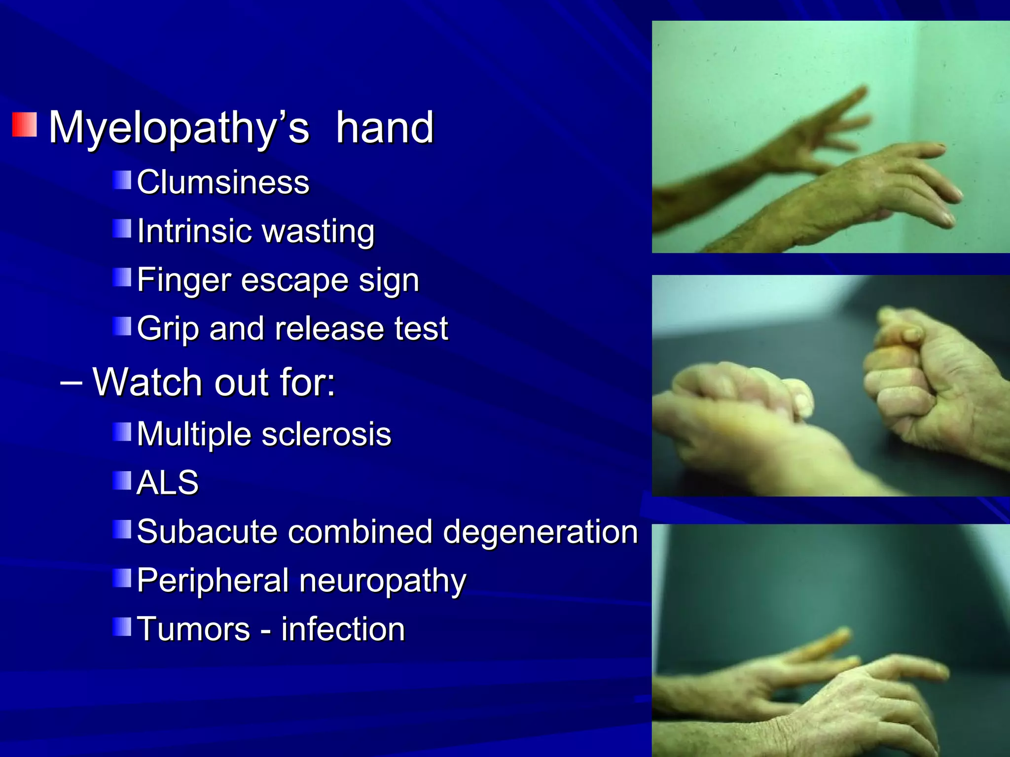 Cervical Myelopathy 2016 | PPT